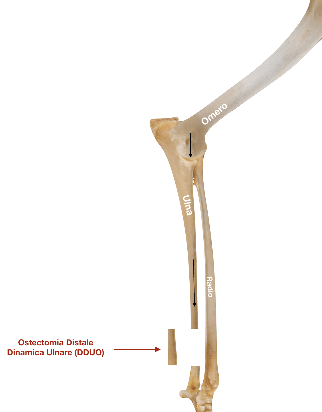Ostectomia dinamica distale dell'ulna | RSV